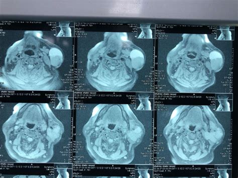 Total Left Parotidectomy For Recurrent Adenoma Dr Raad Al Saffar