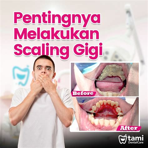 Pentingnya Scaling Gigi Tami Dental Care Klinik Gigi Dokter Gigi Terbaik Terpercaya Di