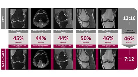 simultaneous multi slice siemens healthineers