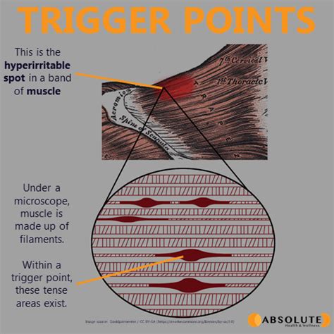 What Are Trigger Points Absolute Health Wellness