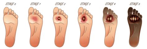 Staph Infection On The Toe Or Foot Early Signs And Best Treatment