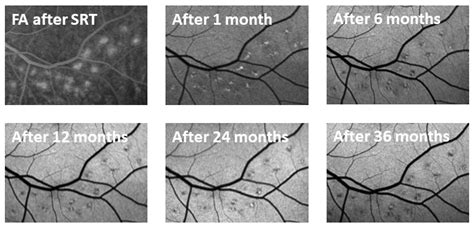 Long Term Multimodal Imaging Analysis Of Selective Retina Therapy Laser Lesions