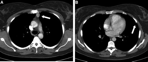 Ct Scan Of The Chest Showing A Well Circumscribed Homogeneously