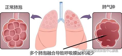 慢阻肺为什么先出现缺氧后出现二氧化碳潴留 知乎