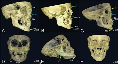 Three Dimensional Computed Tomographic Measurements A Lateral View