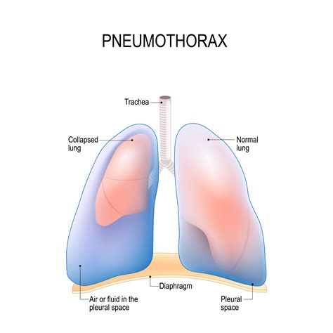 Tension Pneumothorax Needle Decompression