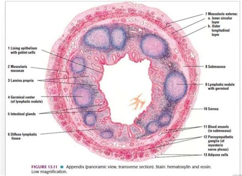 Pathology Of Acute Appendicitis Its Etiology Morphology Gross Appearance And Microscopic View