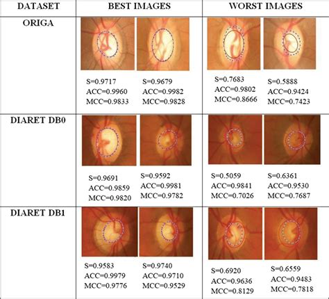 the best and worst cases for oc segmentation of the proposed algorithm