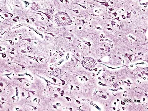 neurofibrillary tangles