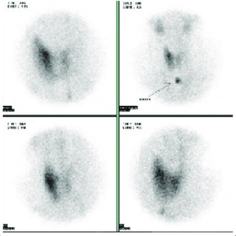 Pertechnetate Scan Showing Large Hypofunctioning Nodule Occupying The Download Scientific