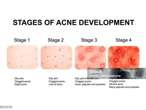 여드름의 개발 단계 흉터 여드름 및 여드름으로 염증이 있는 피부 염증이 있는 피부 여드름 뾰 루지의 감촉 인포 그래픽 벡터 일러스트입니다 건강관리와 의술에 대한 스톡 벡터