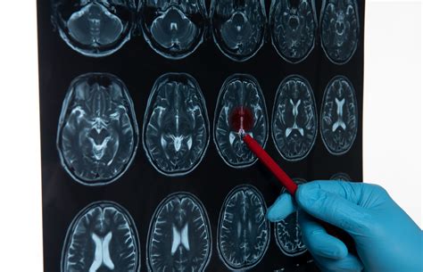 Patient Risk For Medication Non Adherence Implementation Of Classify Center For Applied Ai