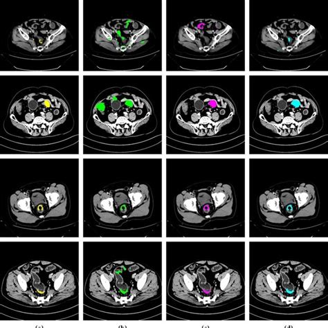 Four Groups Of Colorectal Segmentation On Test Dataset A The Ground Download Scientific