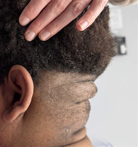 Male Occipital Scalp Roll Side 1 Dr Barry Eppley Explore Plastic Surgery