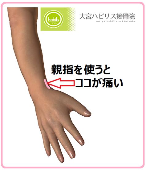 親指を動かすと、手首が痛い 『ドゥケルヴァン病』 大宮ハビリス接骨院｜院長ブログ