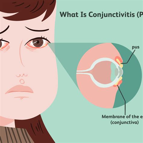 Awesome Info About How To Deal With Conjunctivitis Warningliterature