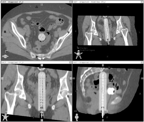 Brachytherapy Planning Ct Scan Images In Planes Show Hot Sex Picture