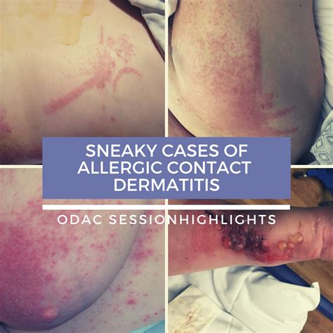 Sneaky Cases Of Allergic Contact Dermatitis Next Steps In Dermatology