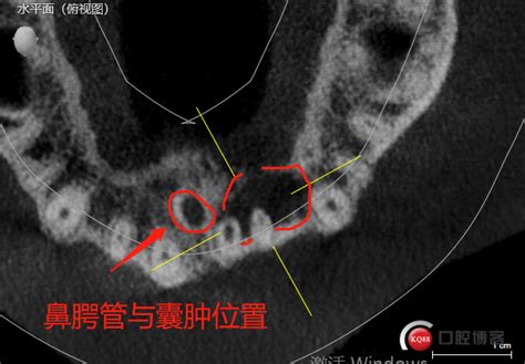 左上前牙区根尖囊肿刮治术