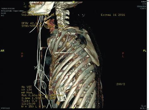 Three Dimensional Computed Tomography Scan Note The Foreign Body