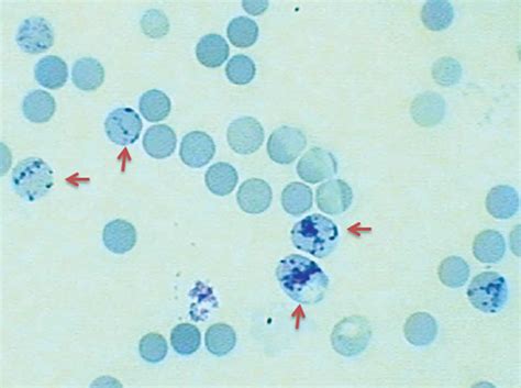 Reticulocytosis Definition Causes Diagnosis And Treatment