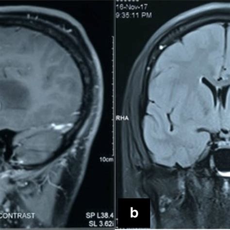 Primary Intracranial Ewing Sarcoma Peripheral Primitive