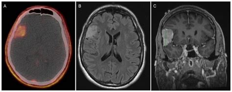 🚨 Psma Uptake Beyond Prostate Cancer Meningioma 𝐎𝐧𝐜𝐓𝐡𝐞𝐫𝐚𝐗