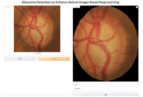 Optimizing Glaucoma Diagnosis With Deep Learning Based Segmentation And