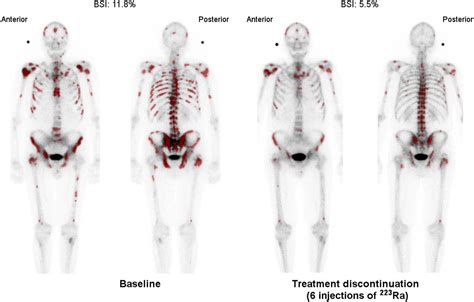 Assessing Radiographic Response To 223ra With An Automated Bone Scan Index In Metastatic