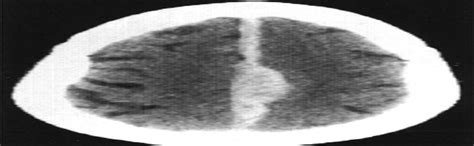 Interhemispheric Subdural Hematoma In Adults Case Reports A Neurosurgery