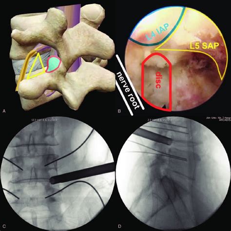 Nerve Root Decompression Was Conducted Under Endoscopic The Red Arrow