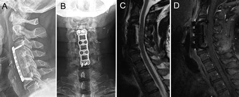 Postoperative Lateral A And Posteroanterior B Radiographs Showing