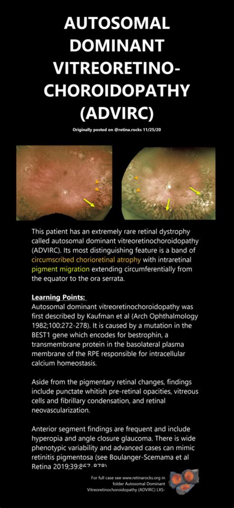 Inherited Retinal Diseases Autosomal Dominant Vitreoretinochoroidopathy Advirc Retina Rocks