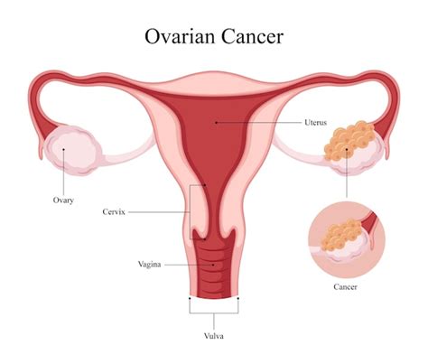 Premium Vector Ovarian Cancer Gynecology Infographic