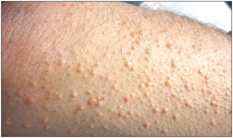 Eruptive Xanthomas In A Patient With Severe Hypertriglyceridemia And Type 2 Diabetes Cmaj