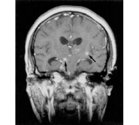 Case 4 Cryptococcoma In Bi Lat Eral Tem Po Ral Lobes Co Ro Nal Sec Download Scientific