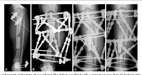 Figure 2 From Bone Transport With The Taylor Spatial Frame Technique A Case Series Semantic