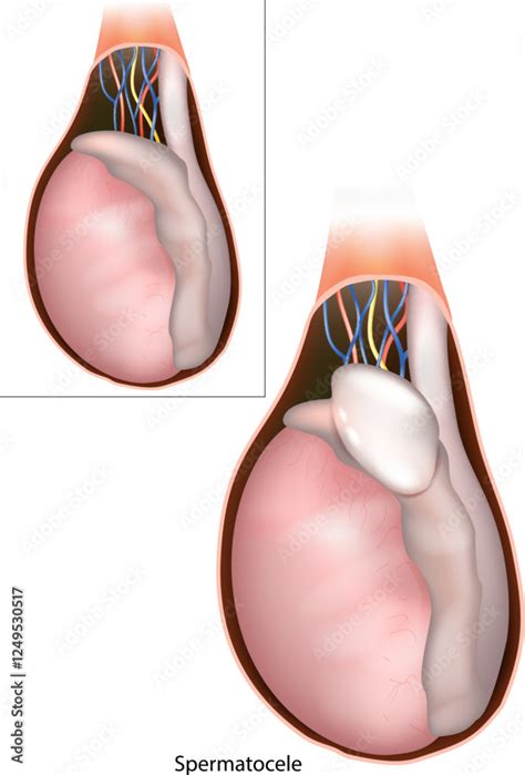 Spermatocele Medical Illustration Spermatocele Cyst In Epididymis