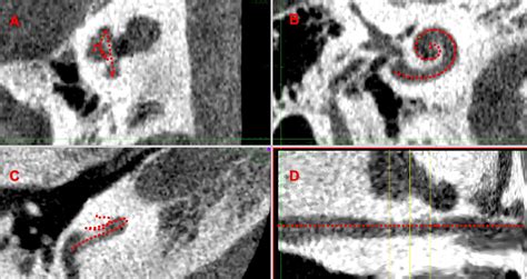 Determination Of Cochlear Duct Length With 3d Versus Two Dimensional Methods A Retrospective