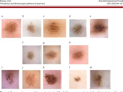 Figure 1 From Prevalence And Dermoscopic Patterns Of Acral Melanocytic Nevi In Turkey