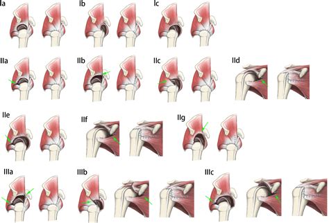 Massive Rotator Cuff Tears Geometric Classification Complete Repair