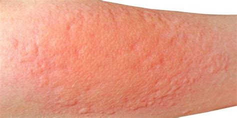 Contact Dermatitis Treatments Slo Coastal Dermatology
