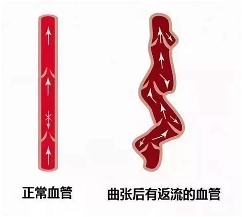 精索静脉曲张高清大图图片 有来医生