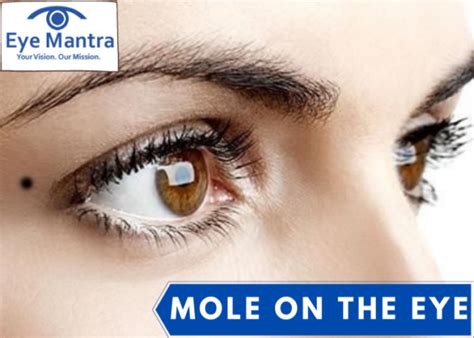 Eye Mole Nevuseye Freckle Types And The Treatment