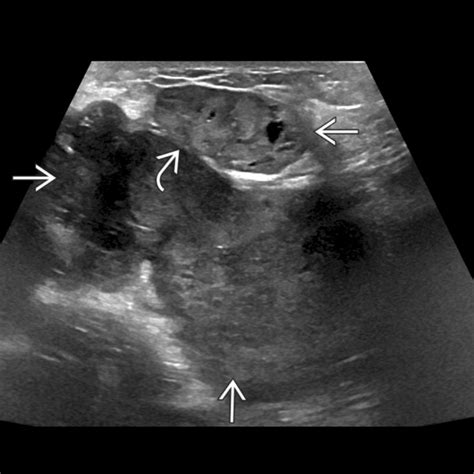 Peritoneal Carcinomatosis Radiology Key