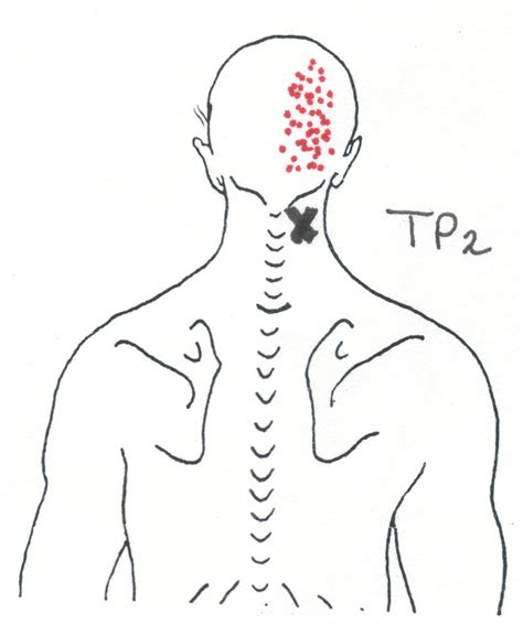 Splenius Capitis Trigger Points