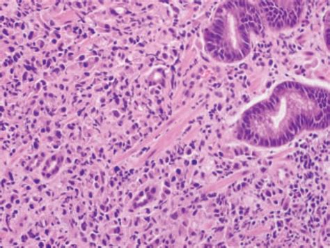 Pathology Of Gastric Biopsy In March 2013 Gastric Biopsy Pathology