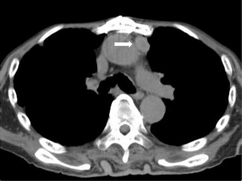 Chest Ct Scan 18 Months After Surgery Mediastinal Lymph Node