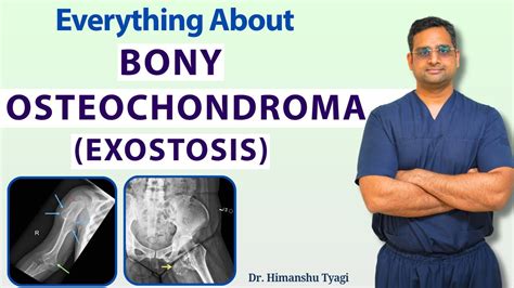 Osteochondroma Knee Treatment