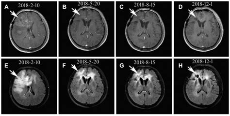 Apatinib Plus Temozolomide For Recurrent Glioblastoma An Uncontrolled Ott